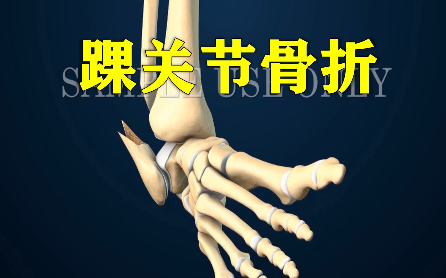 【3D医学动画】踝关节骨折修复(中英双字幕)