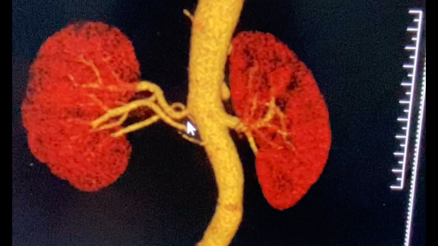 肾动脉CTA 之 左侧副肾动脉,右侧肾段动脉分叉早。