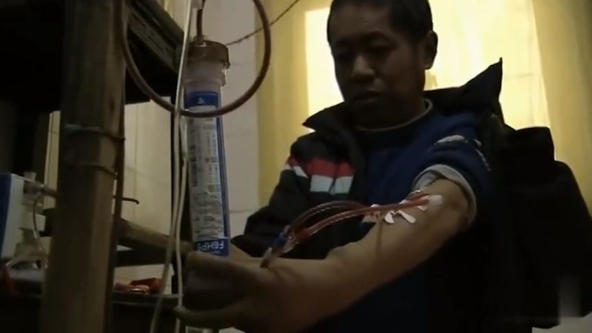 男子自制简易的血液透析机,在家自己做血透,竟持续了14年之久