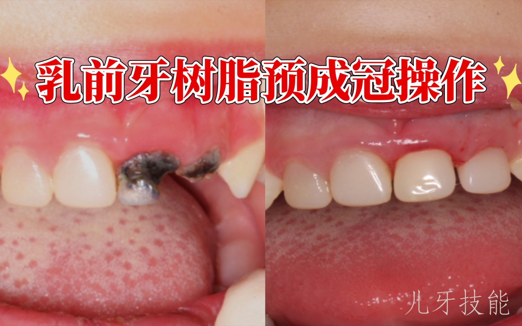 【口腔技能】乳前牙树脂预成冠操作视频