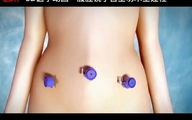 3D医学动画:腹腔镜子宫全切手术