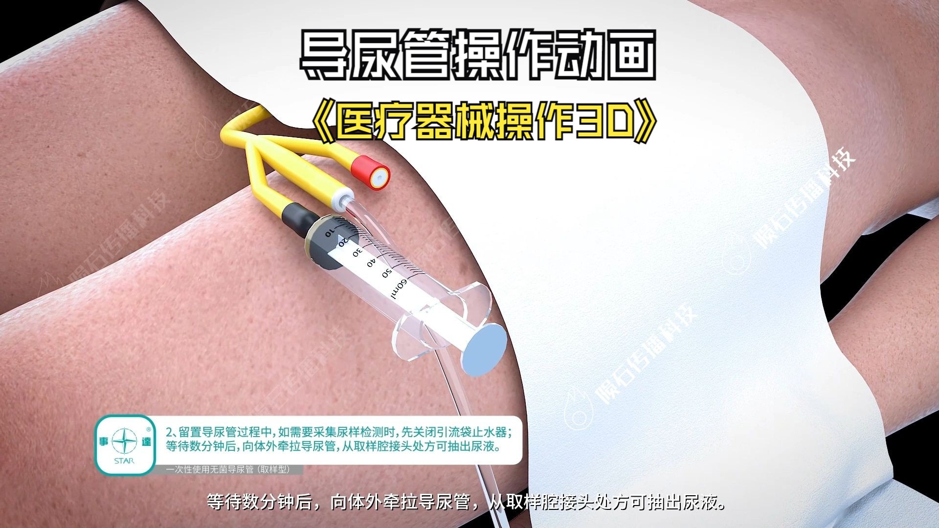 取样型导尿管操作动画