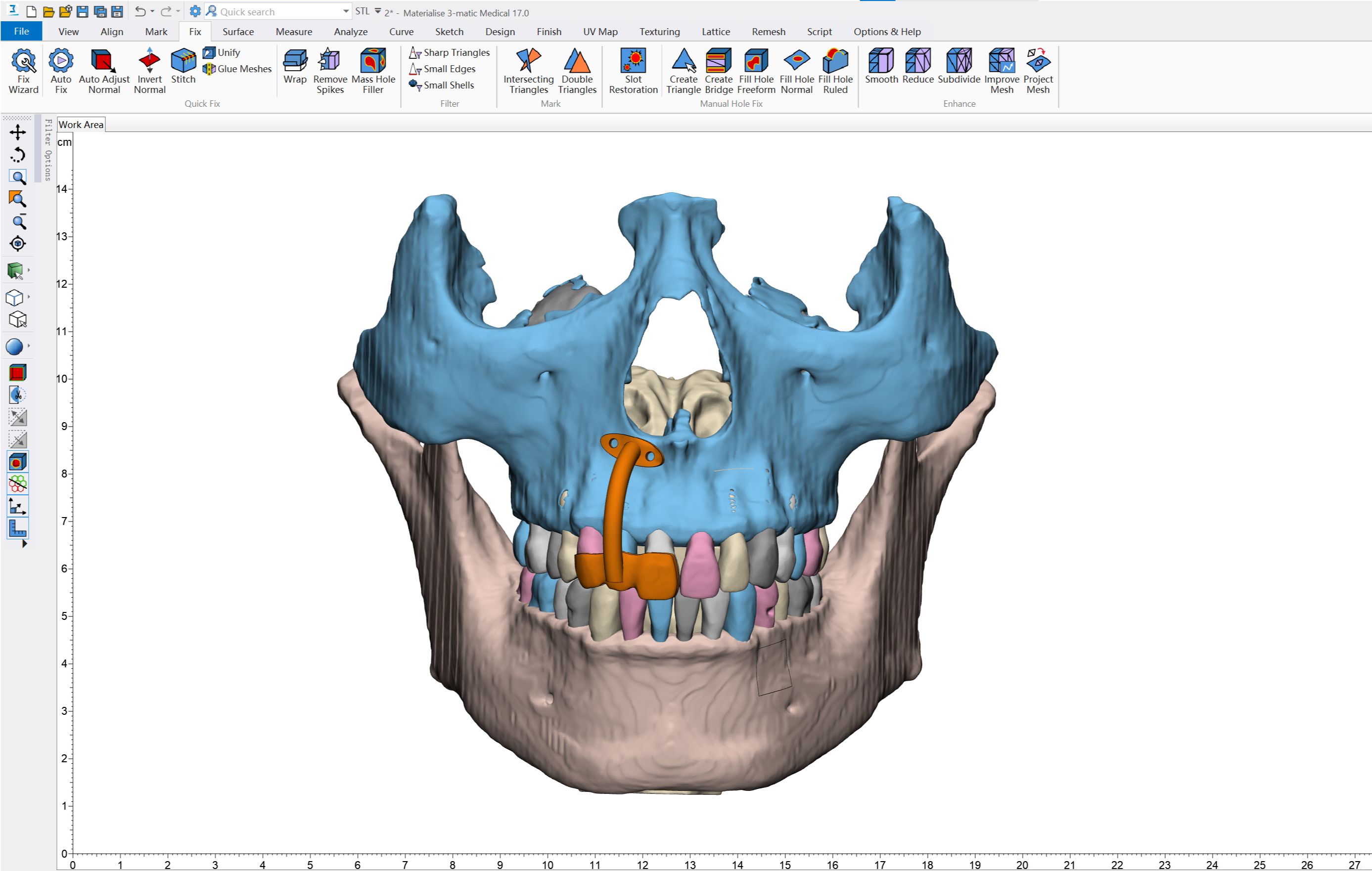 Mimics、3-matic、Geomagic等软件进行口腔导板设计