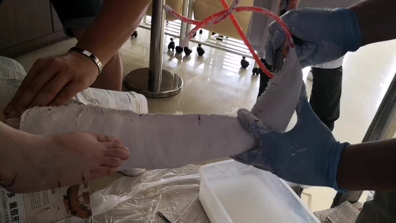 取模的最后过程,拆完石膏以后灌浆,一个新的矫形支具就要新鲜出炉了#...