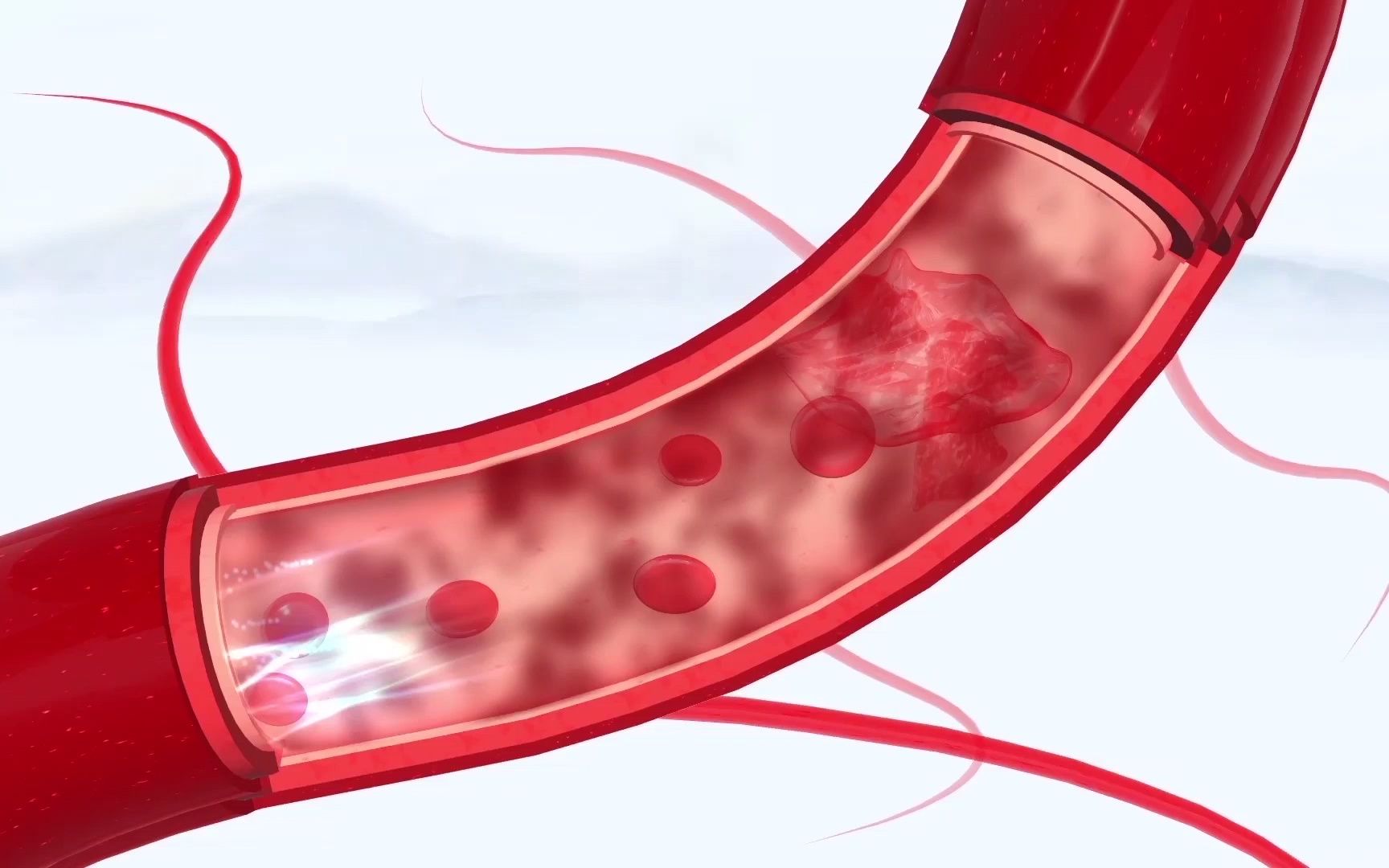 心血管堵塞动画演示说明,真透彻,一下子看懂了