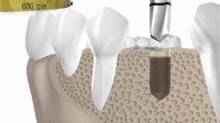 百丹特种植牙系统(Biodenta - Dental Implant System)