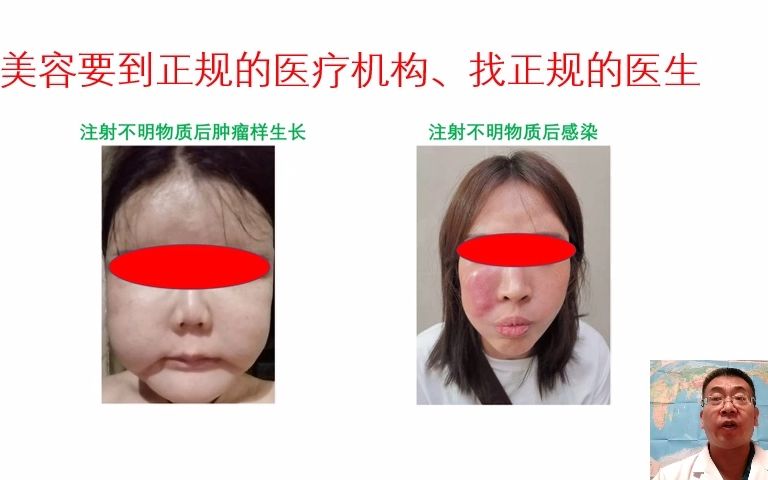 面部注射不明物案例分享!面部注射美容需要到正规医疗机构,找正规医生!