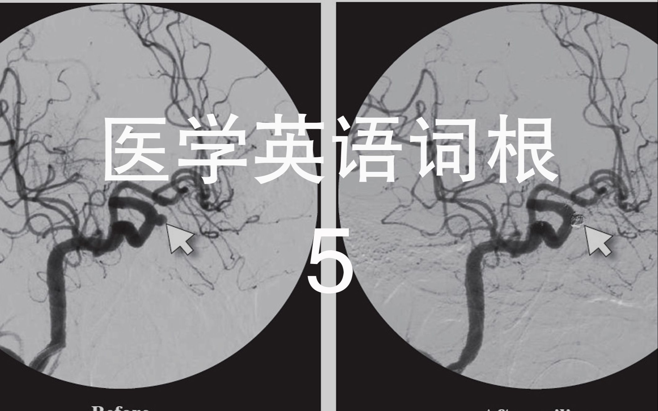 医学英语词根学习5——缺血再灌注损伤用英语怎么说,看完你就明明白...