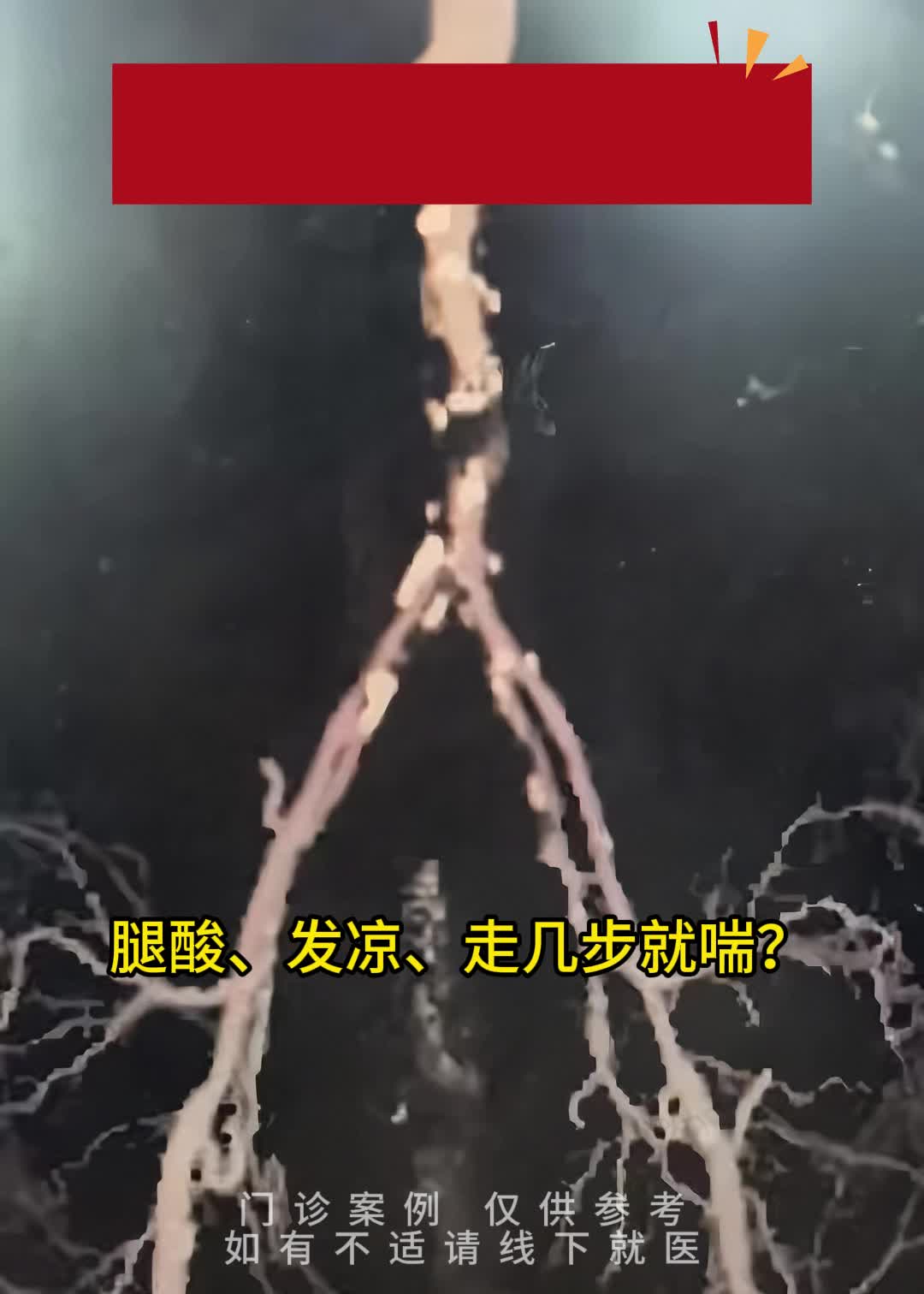 主髂动脉闭塞是全身性动脉粥样硬化的局部表现,治疗需综合评估缺血...