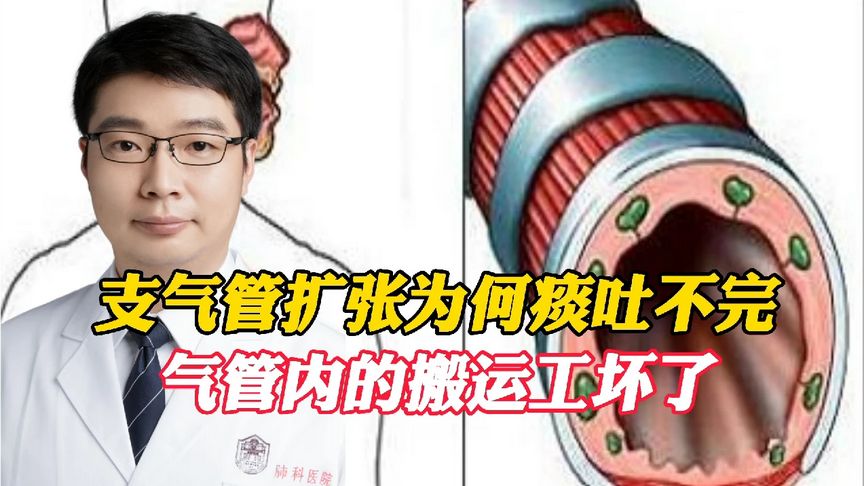 支气管扩张患者为什么痰吐不完?这是因为气管内的搬运工坏掉了