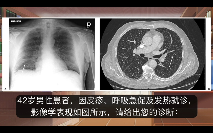 皮疹、发热,以及两肺弥漫分布的粟粒结节--水痘带状疱疹病毒性肺炎