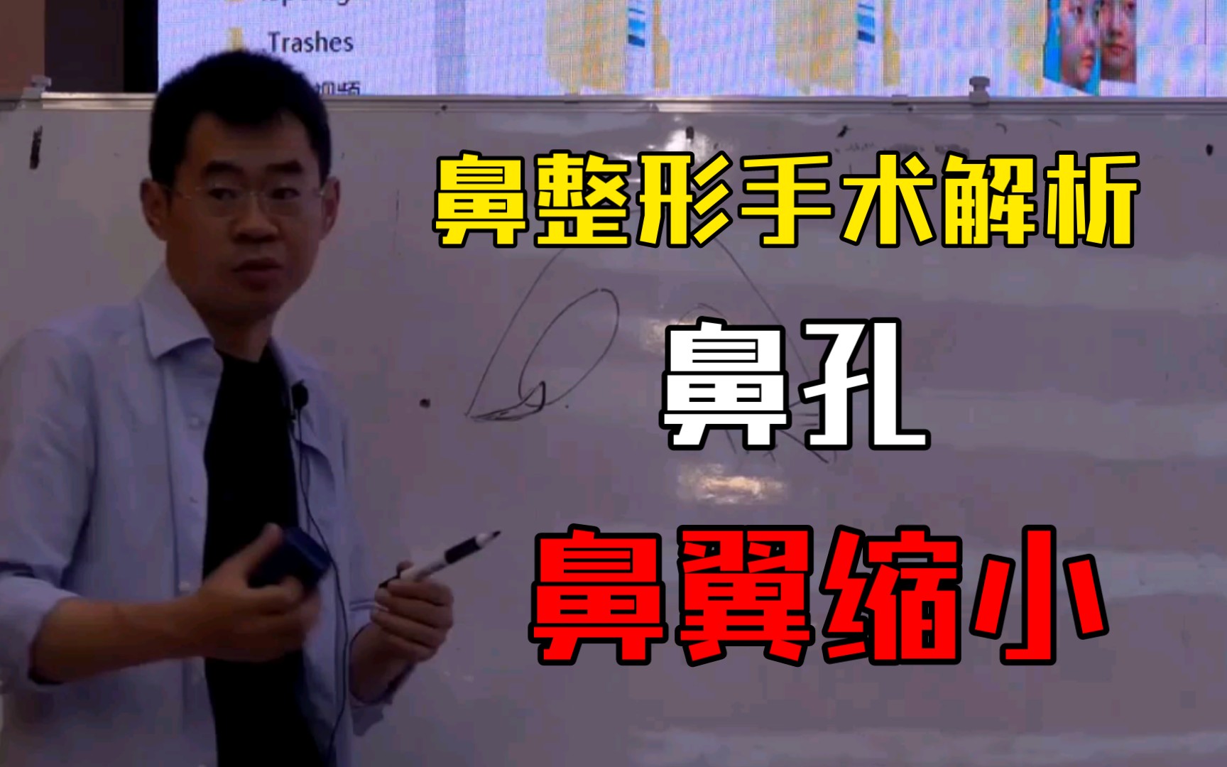 鼻孔、鼻翼的缩小是怎么做?有哪些方式?