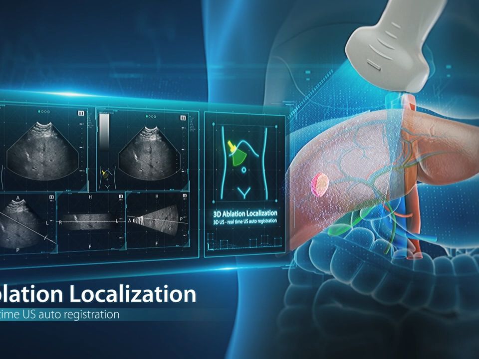 三维超声引导下的肝脏肿瘤频消融治疗