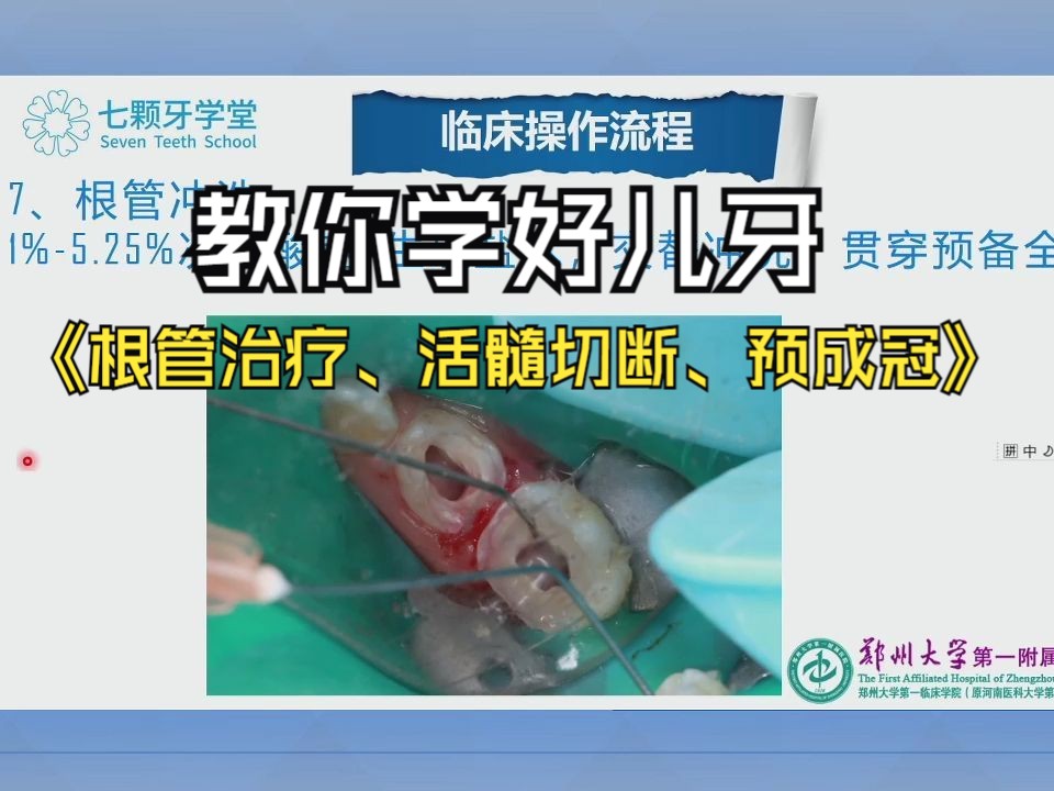 儿牙临床实战八术:根管治疗、活髓切断、金属预成冠讲解——七颗牙...