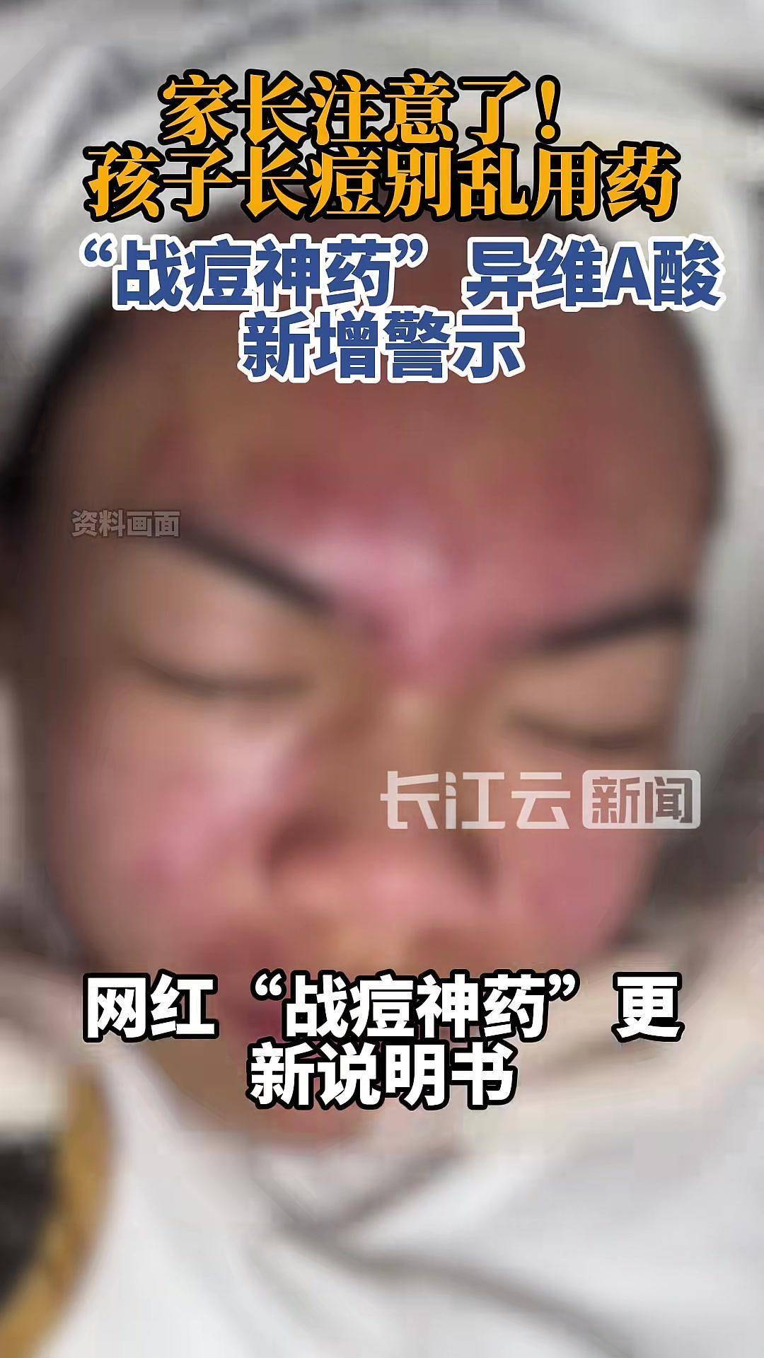 家长紧急注意!孩子长痘慎用"战痘神药"!异维A酸新增警示