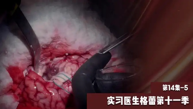 实习医生格蕾第十一季:颅内放粒子,险象环生!(208)