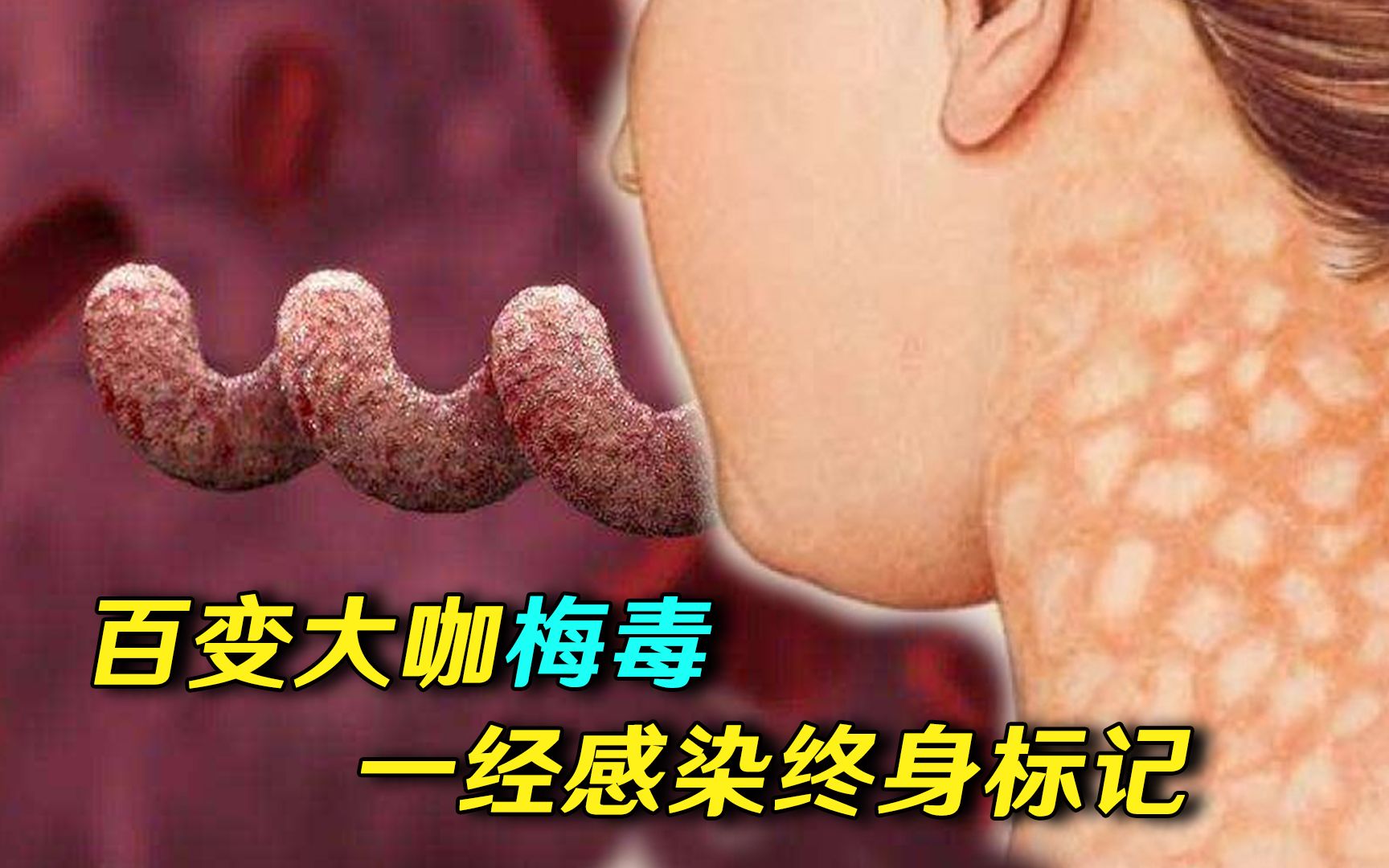 一经感染,终身标记,梅毒到底有多可怕?