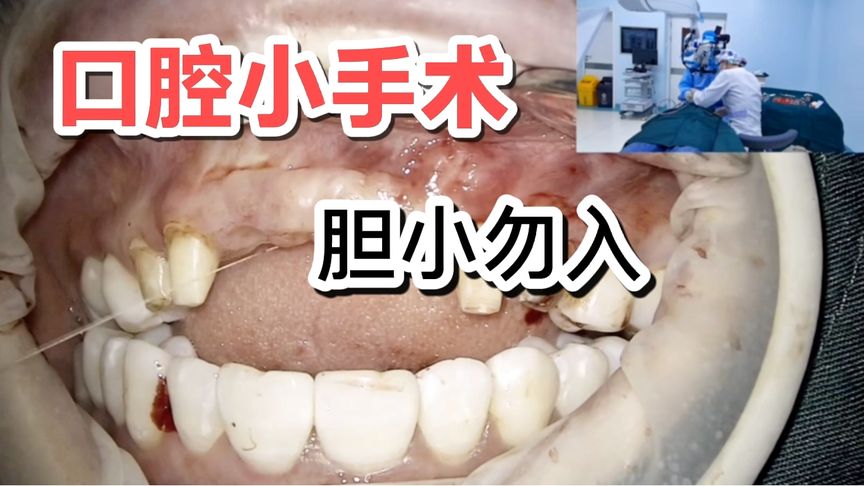 结缔组织放置隧道瓣内,口腔小手术,胆小勿入