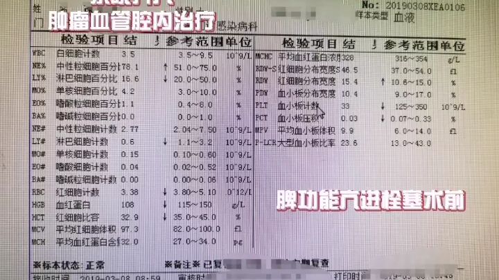 脾动脉栓塞治疗脾功能亢进