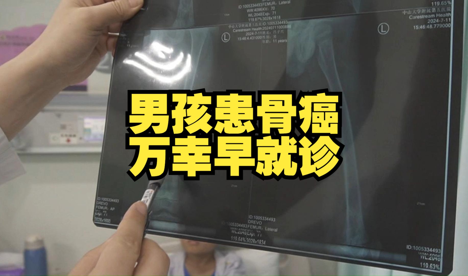 孩子腿疼,及时就医,发现患骨癌!万幸家长警惕性高,越早诊治,少走弯路。