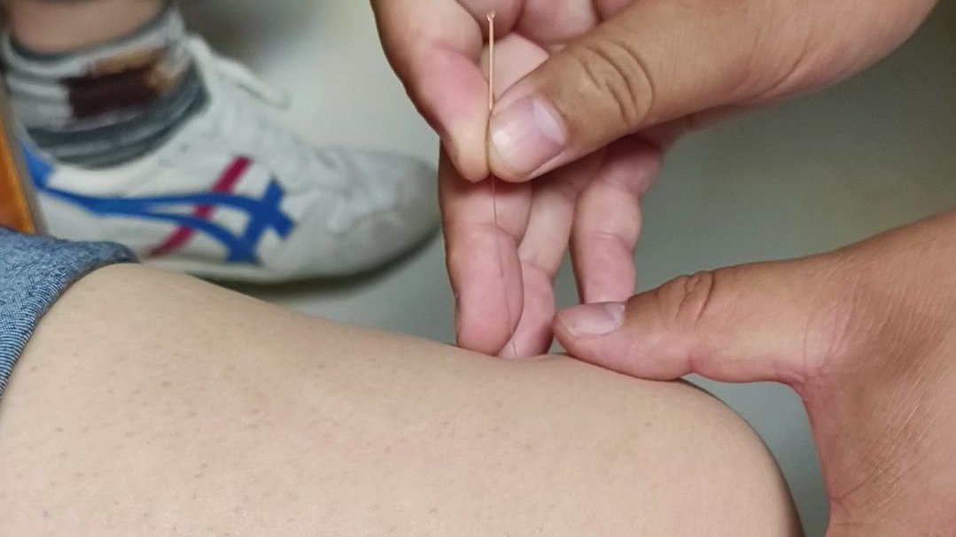 血海穴取穴及针刺精要