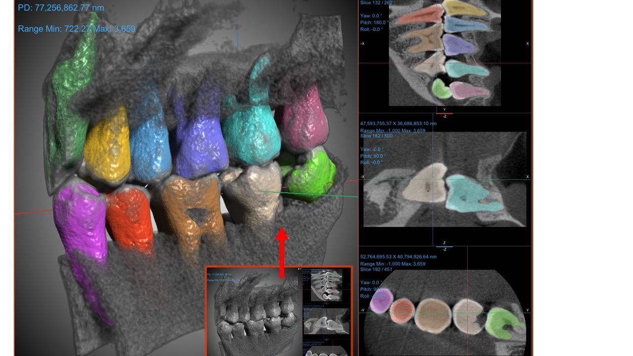 【Dragonfly2025教程】36 AI深度学习分析牙齿CBCT数据 (SAM & ...
