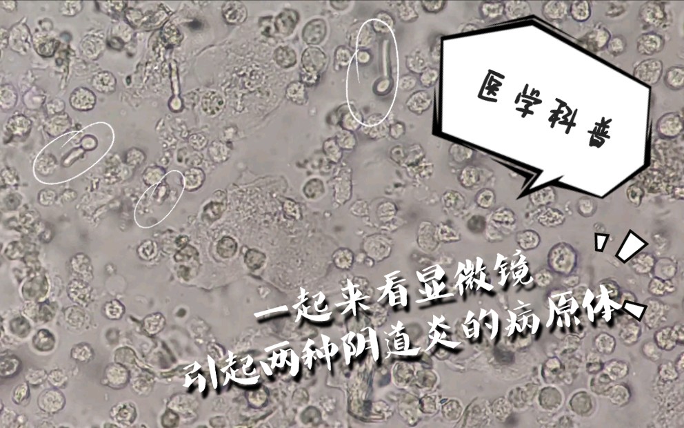 白带里的真菌和阴道毛滴虫
