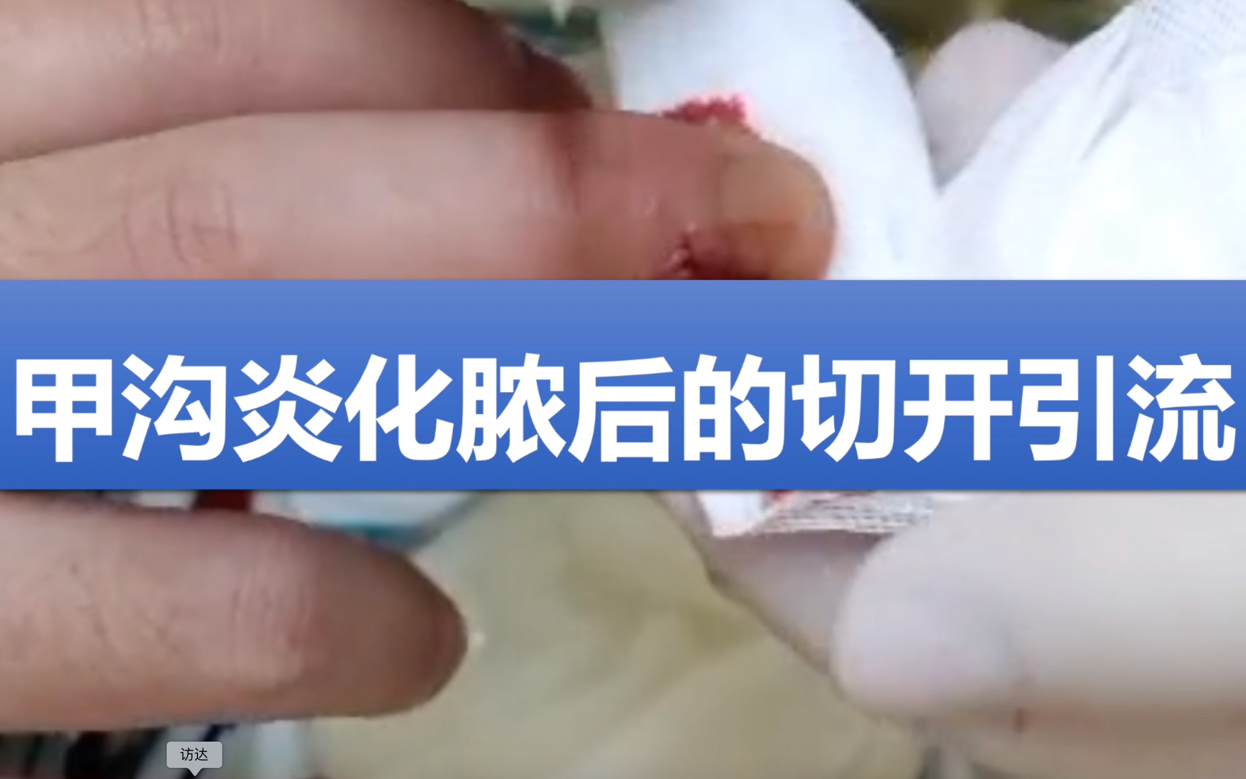 甲沟炎化脓后的切开引流