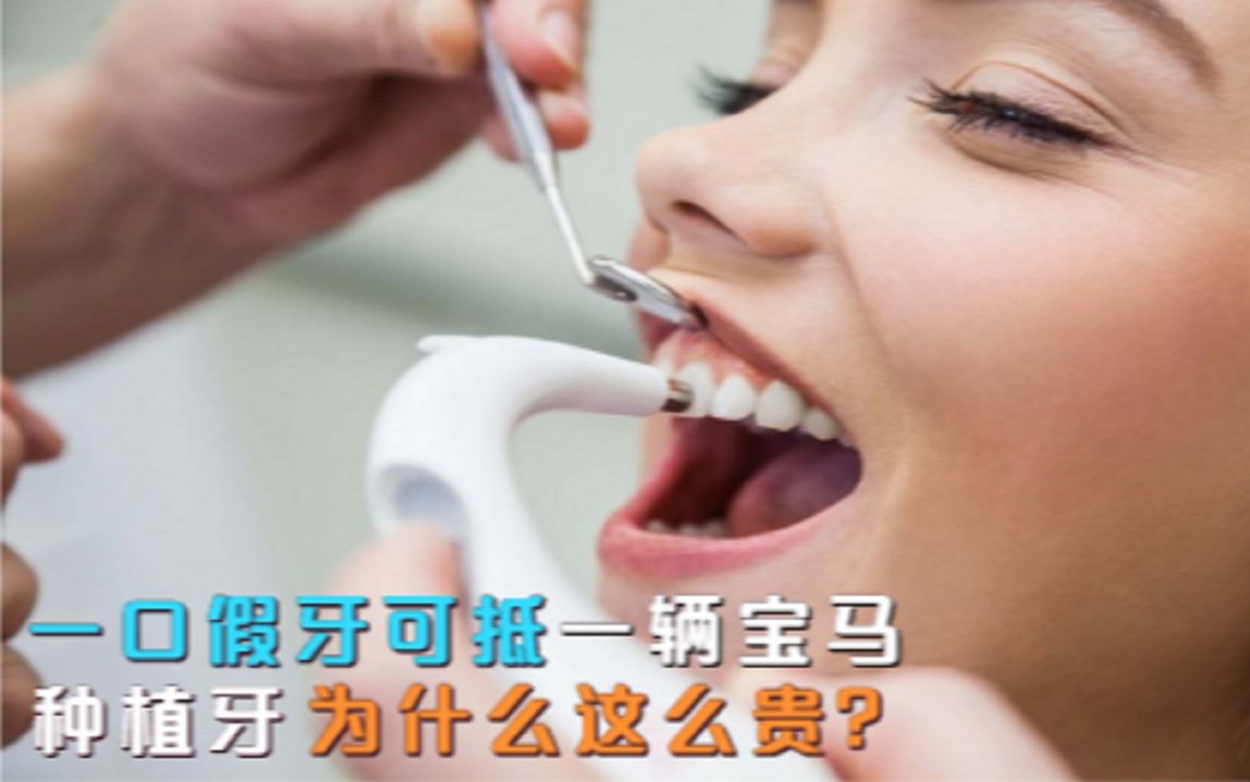 成本百元却卖上万,一口假牙可抵一辆宝马,种植牙为什么这么贵?