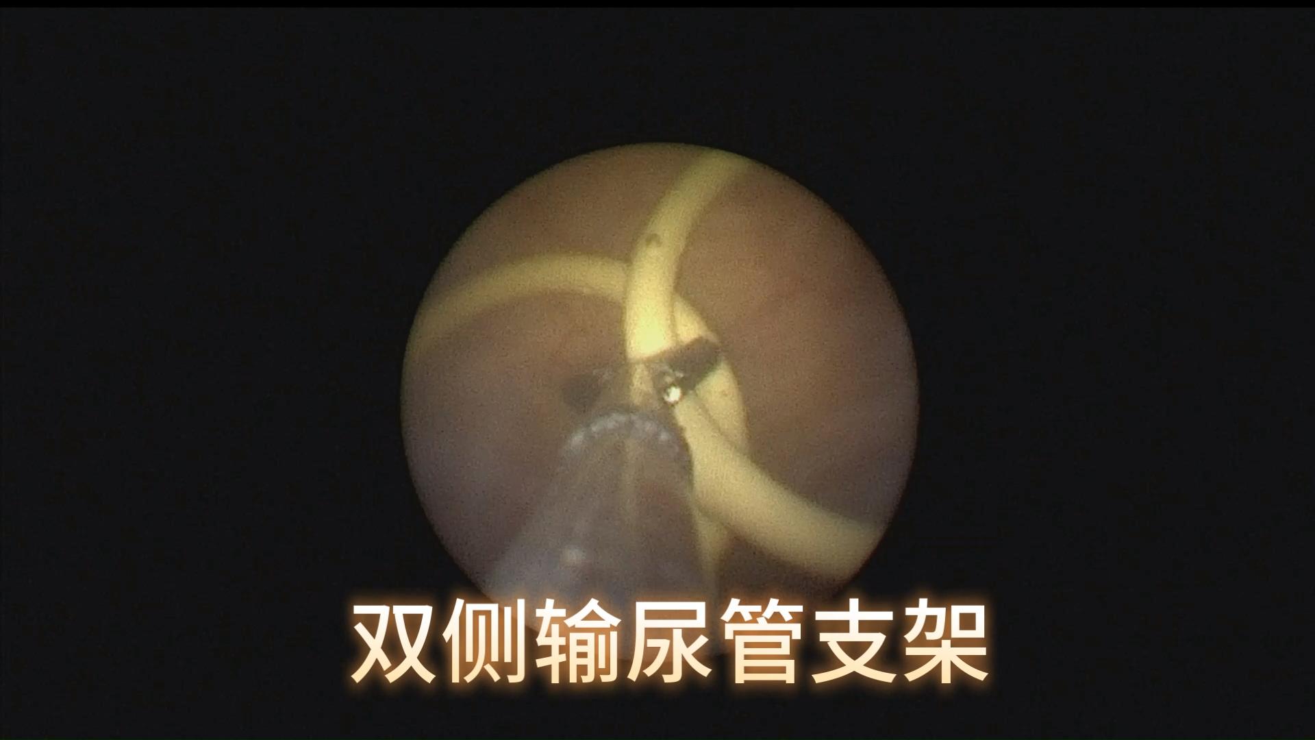 经尿道输尿管支架取出术(双侧、男性)