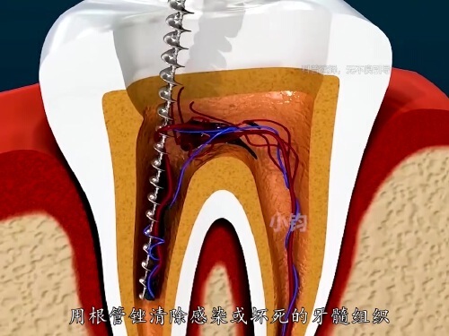 什么是根管治疗?