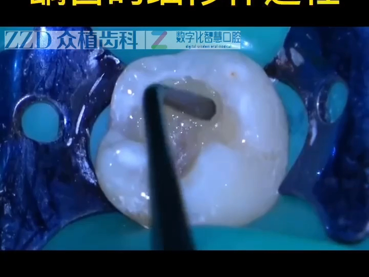 一起来看看龋齿修复的全过程!#龋齿# #补牙# #口腔科普#