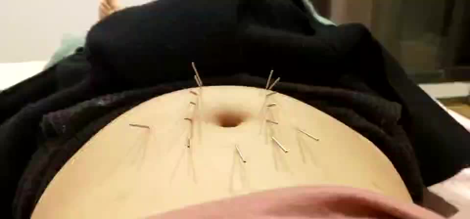 谁知道这针灸有着神奇的功效