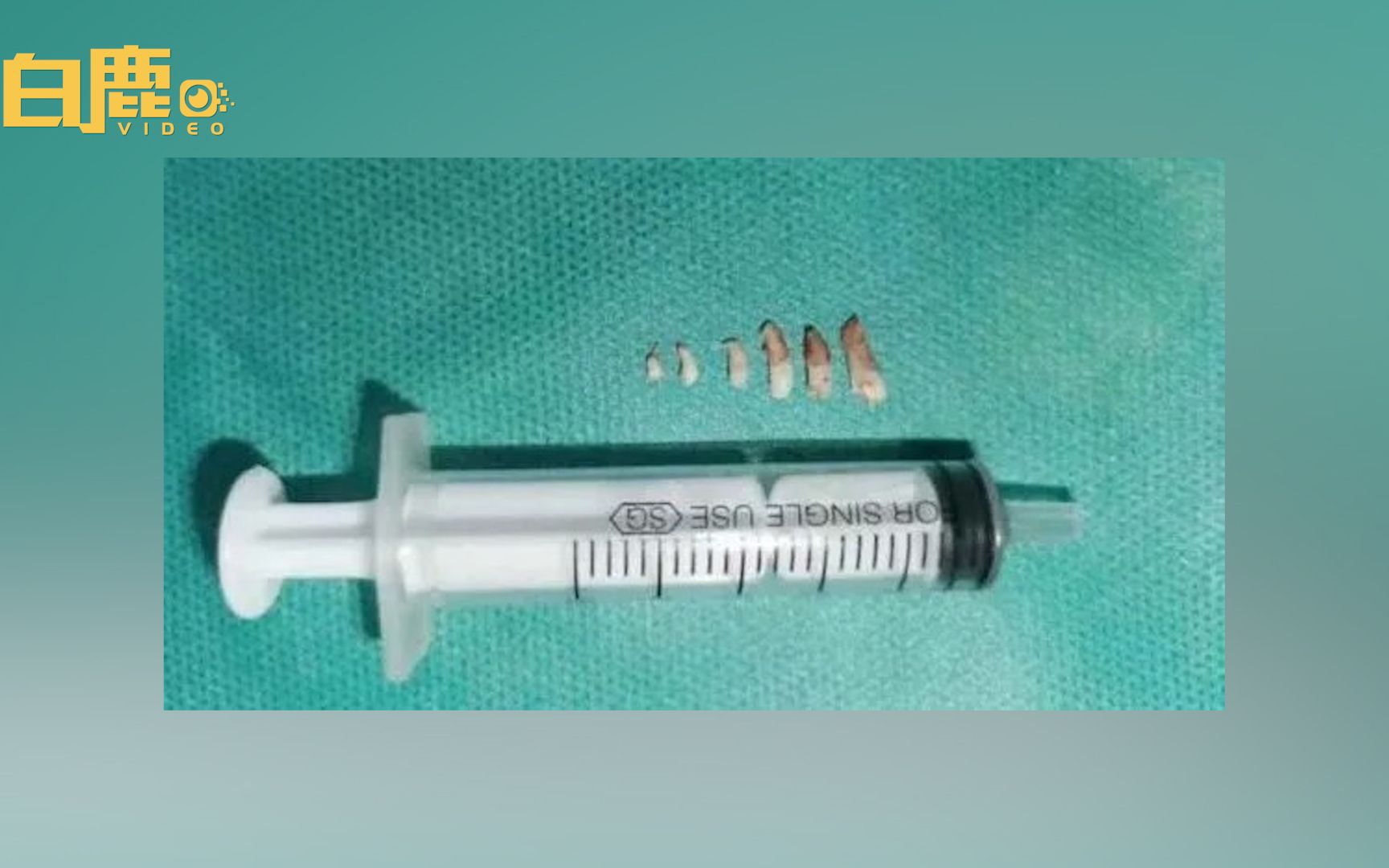 多长6颗“牙”…女子上颚肿胀医生竟拔出6颗牙瘤?医生:大多数人没有...