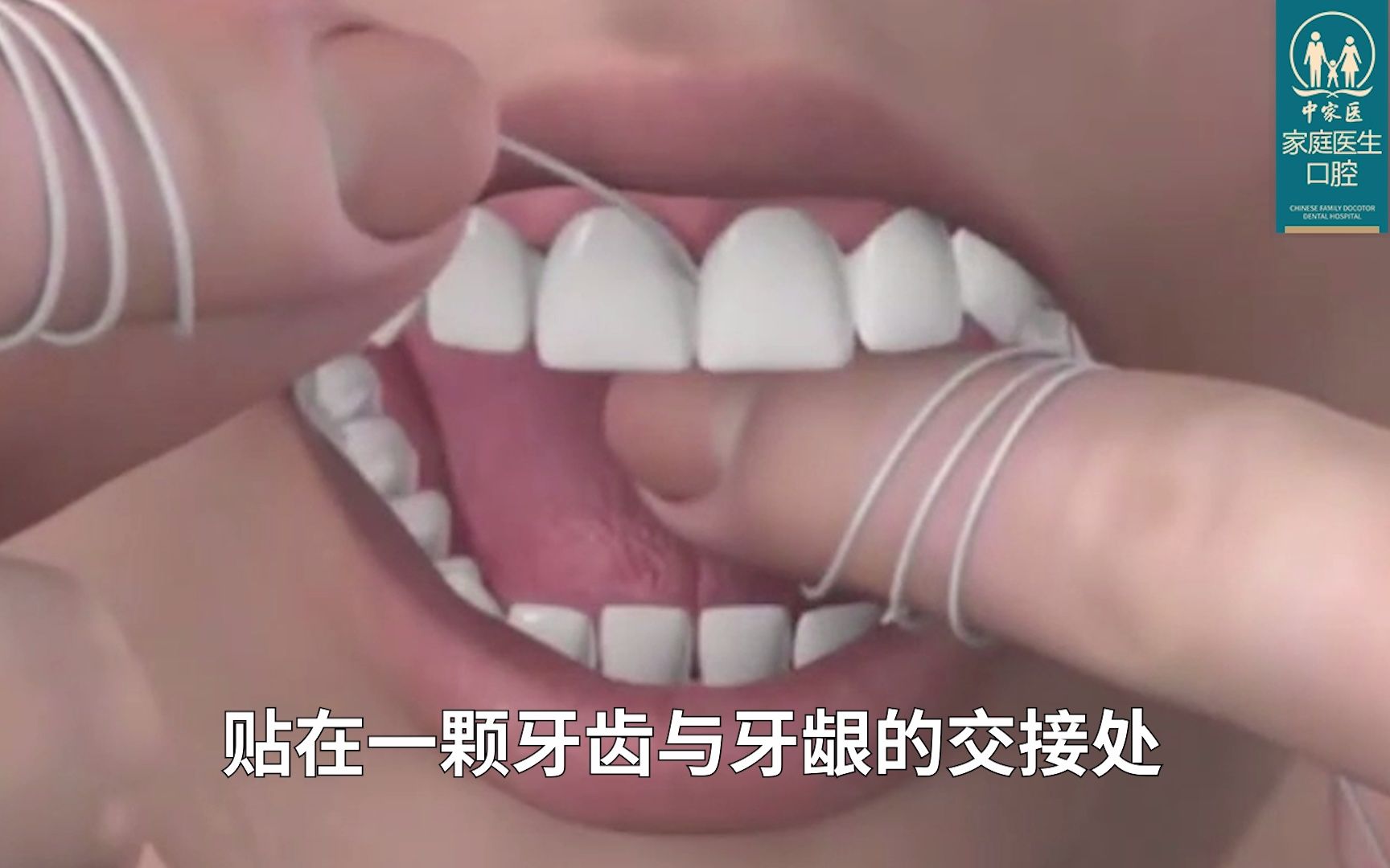 中家医家庭医生口腔：牙线的作用