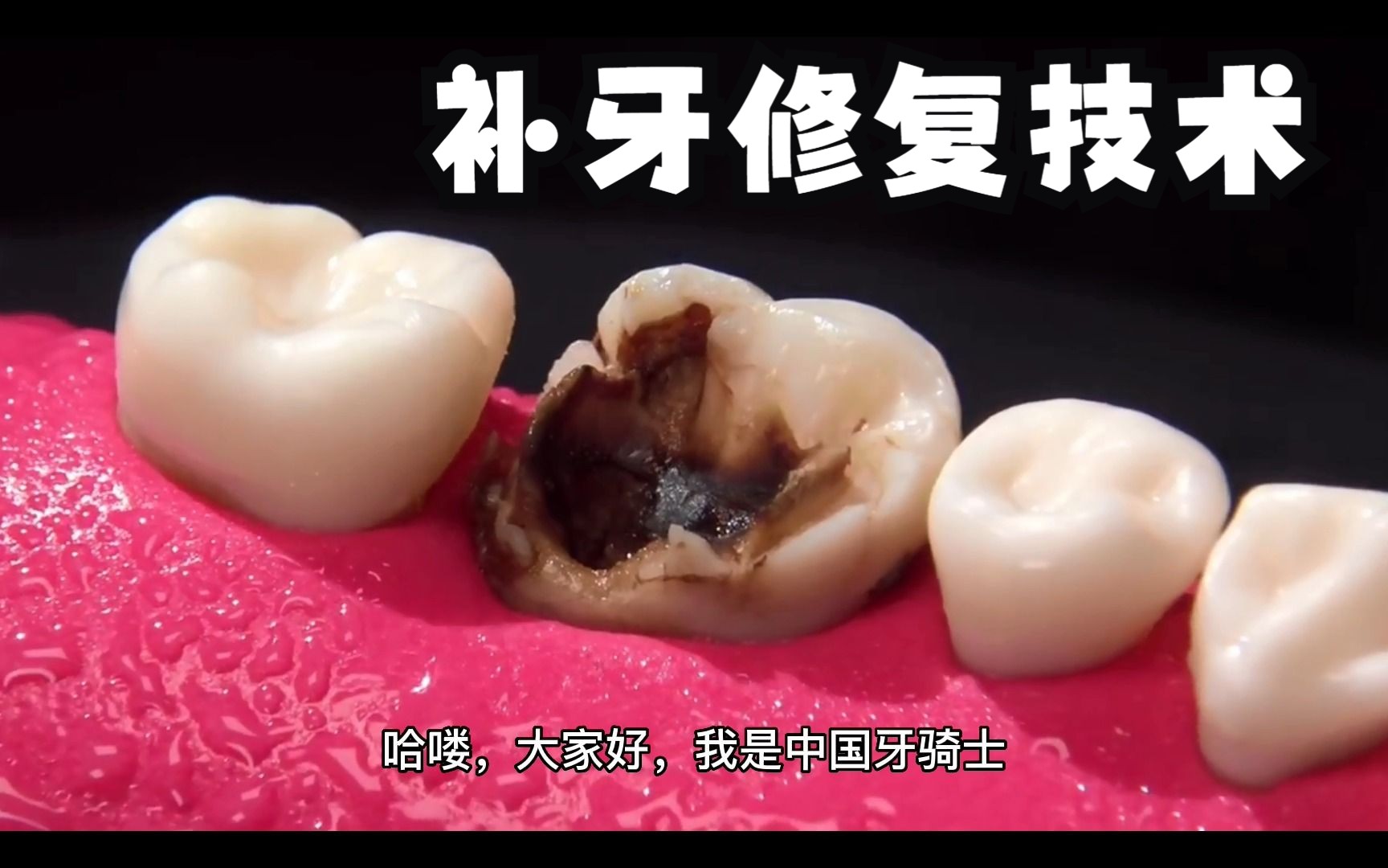 经典的牙齿修复技术过程,看牙避坑指南