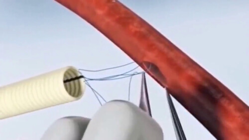 人工血管缝合技术,考验的是医生们的针线活,缝的又快又好很关键!