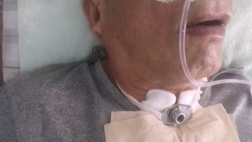 黑河来的气切插管患者,今天第二天,换个管,下一步试堵管,封管