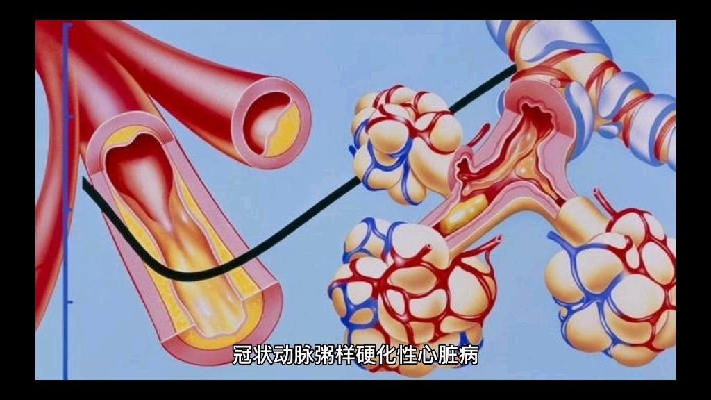 冠状动脉粥样硬化性心脏病