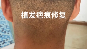 昆明纹发:SMP是目前修复植发疤痕最有效快速的方式