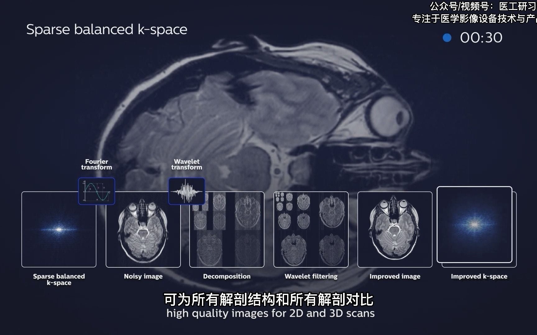 飞利浦磁共振压缩感知成像是怎么样实现的?