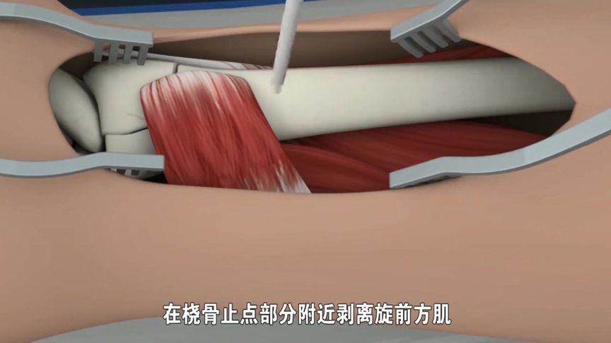 只有猛士才能忍受摔断时的痛,演示手臂桡骨尺骨骨折手术全过程
