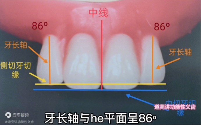 全口排牙方法