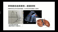 超声引导穿刺原则