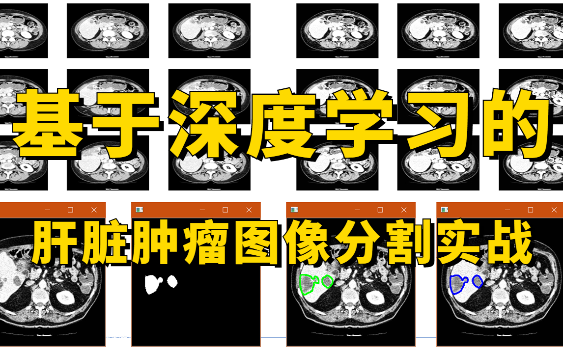 医学人工智能项目实战:基于深度学习的肝脏肿瘤图像分割实战教程,...