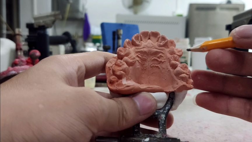 小伙在工厂制作矫正器,看到这牙齿长成奇怪的反颌,还有救吗?