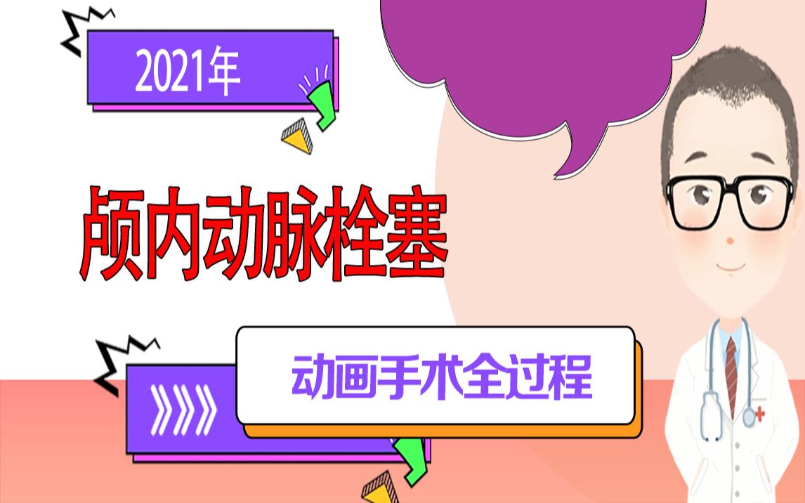 神经内科颅内动脉栓塞术过程动画模拟演示!