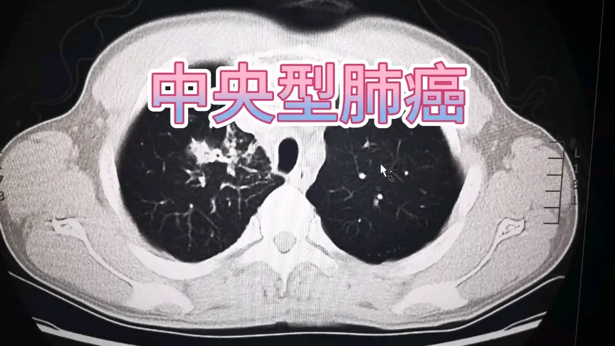 一例中央型肺癌CT表现,直接征象有哪些?间接征象有哪些?