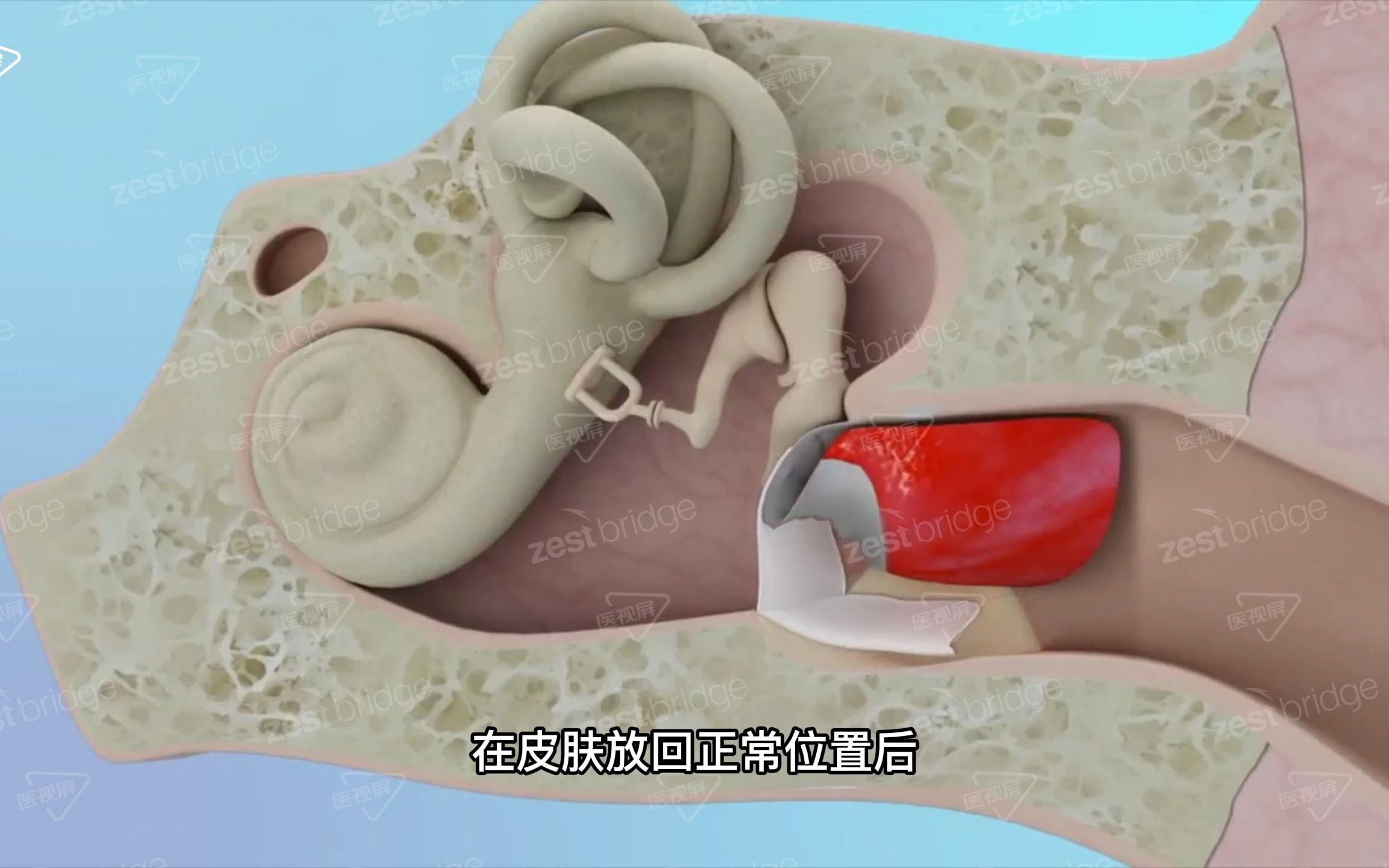 【医学3D】鼓膜穿孔修复术