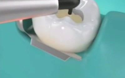 蛀牙不及时处理就需要做根管治疗和牙冠,防止吃东西牙齿崩裂「大连...